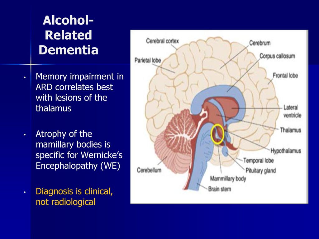 A Complex Relationship Between Alcohol Dementia Morelia Medical Clinic