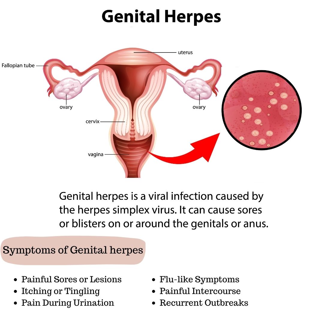 Genital Herpes Morelia Medical Clinic